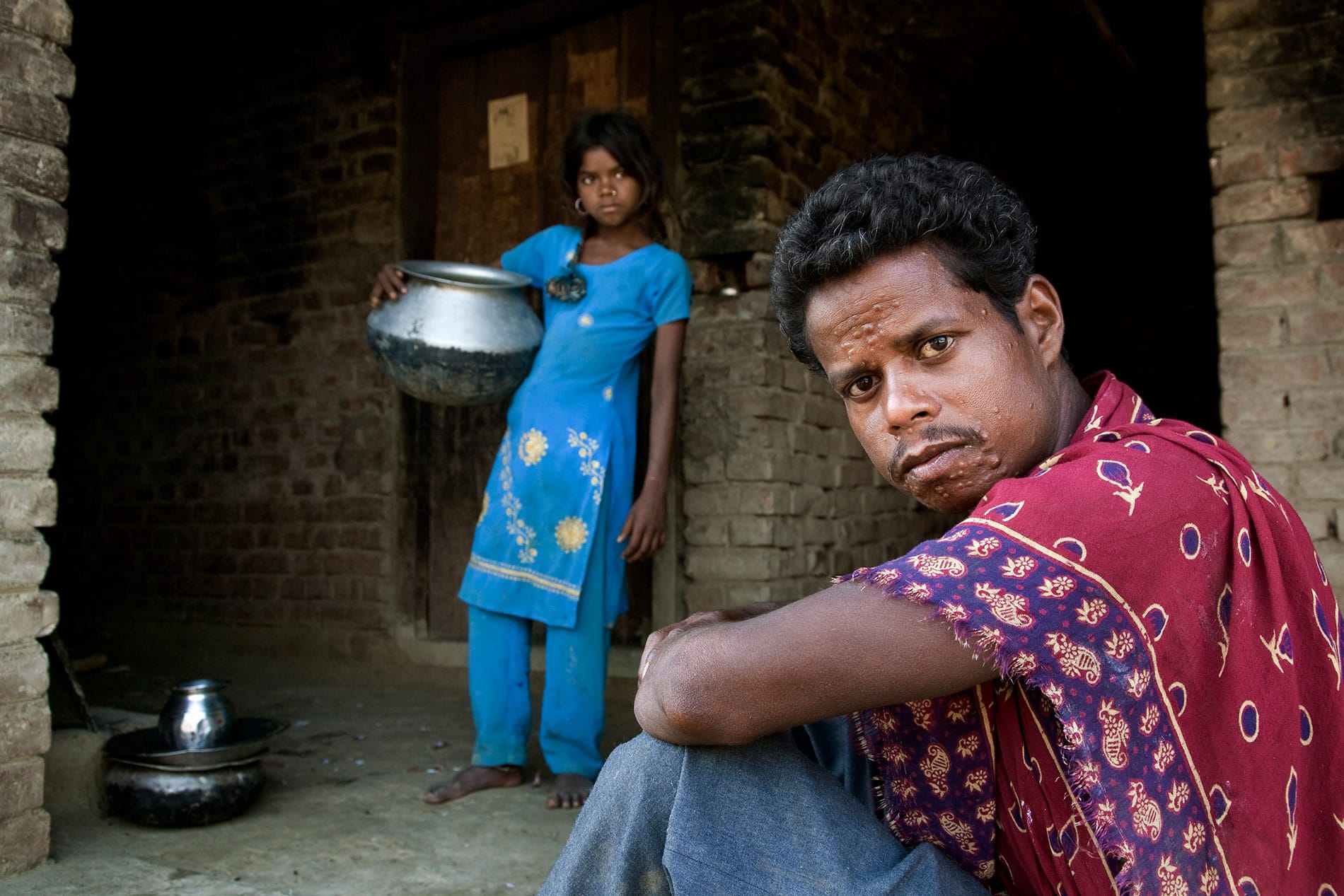 New treatments for PKDL (South Asia) | DNDi